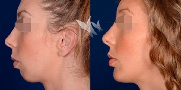 Cirugía de mentón. Procedimiento y postoperatorio - Leclinics