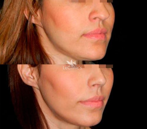 Bichectomía o Extracción de Bolas de Bichat - Leclinics